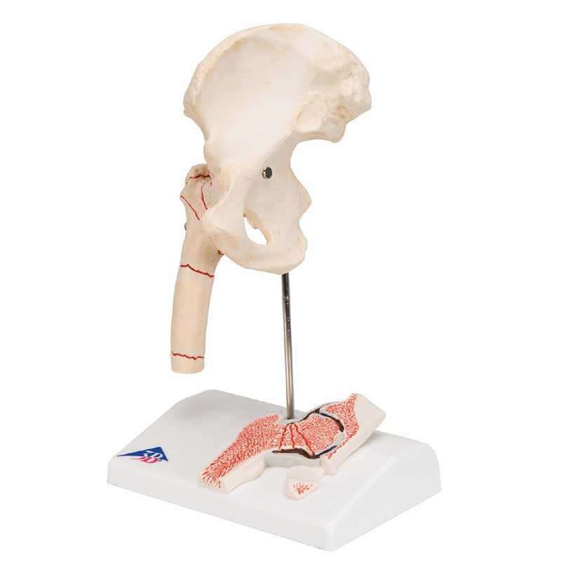 Hip Model w/ Fracture and Osteoarthritis | Health and Care